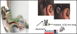 Hearing AIDS (Bone Anchored), ENT hospital in Ahmedabad